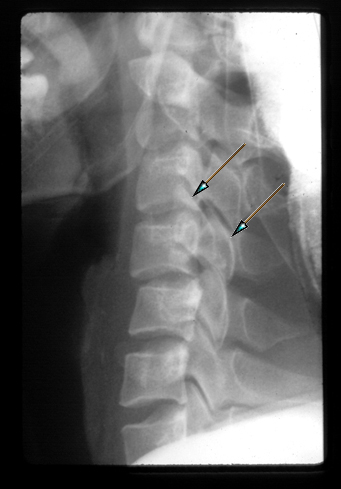 Cervical Facet Dislocations & Fractures - Spine - Orthobullets